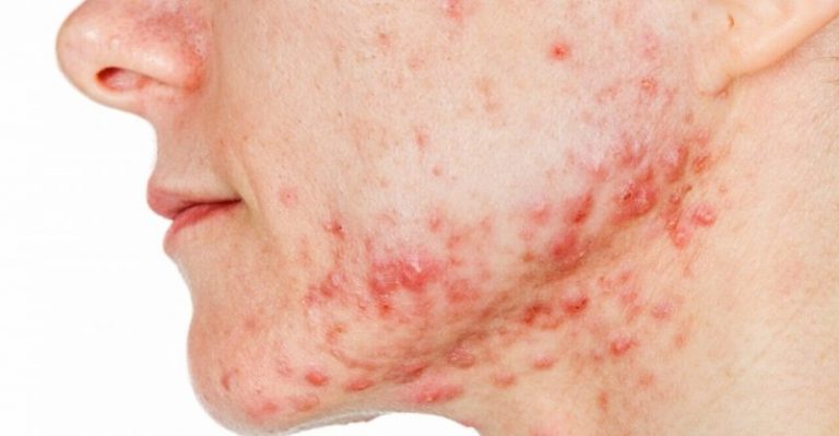 Tratamiento del Acné - Derma Estetic